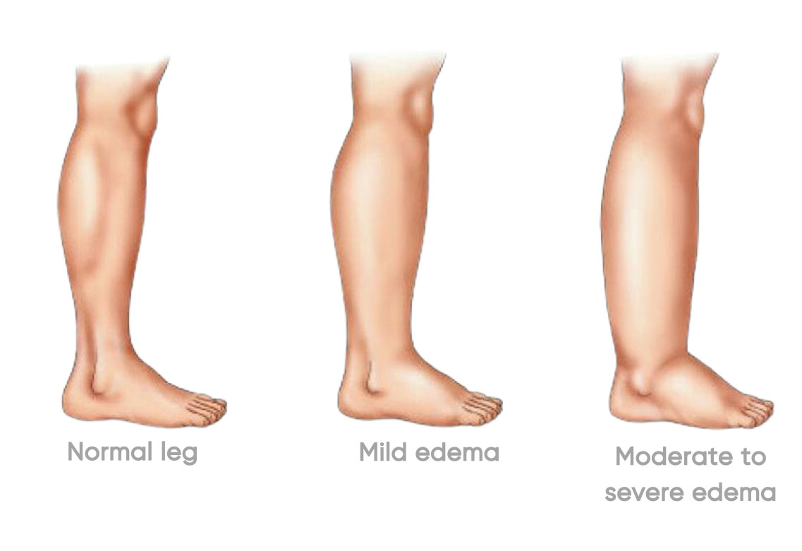 Lymphoedema Sydney Vascular Surgeon Lymphoedema Sydney Vascular Surgeon